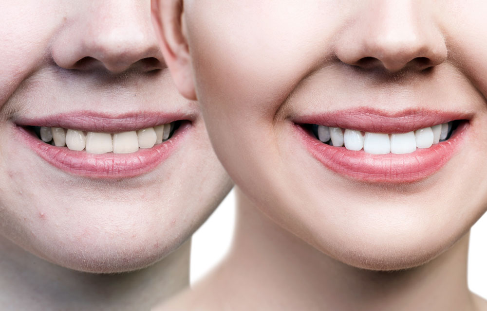 Best Teeth whitening in Bundall | Teeth whitening dental