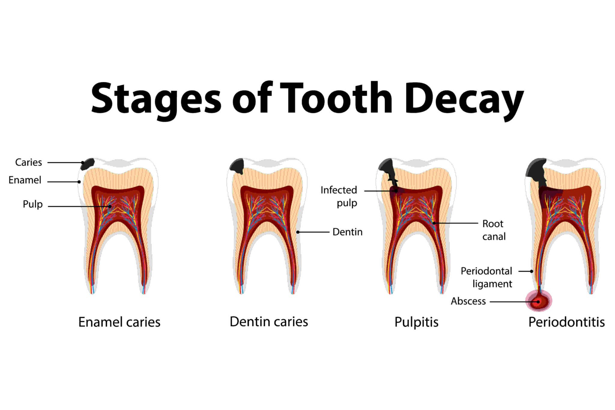 Tooth Decay: Causes, Progression, and Treatments |Bundall Dental and ...